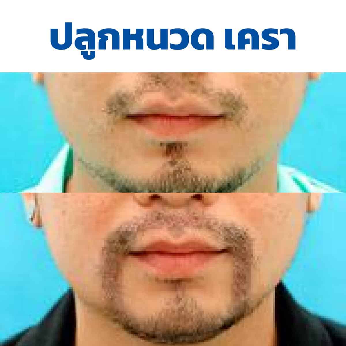 Absolute Hair Clinic คลินิกปลูกผม แก้ผมบาง อย่างถาวร
