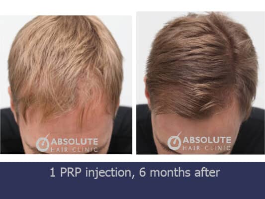 ฉีดเกล็ดเลือดเข้มข้น ฟื้นฟูผมให้แข็งแรงขึ้น - Absolute hair clinic