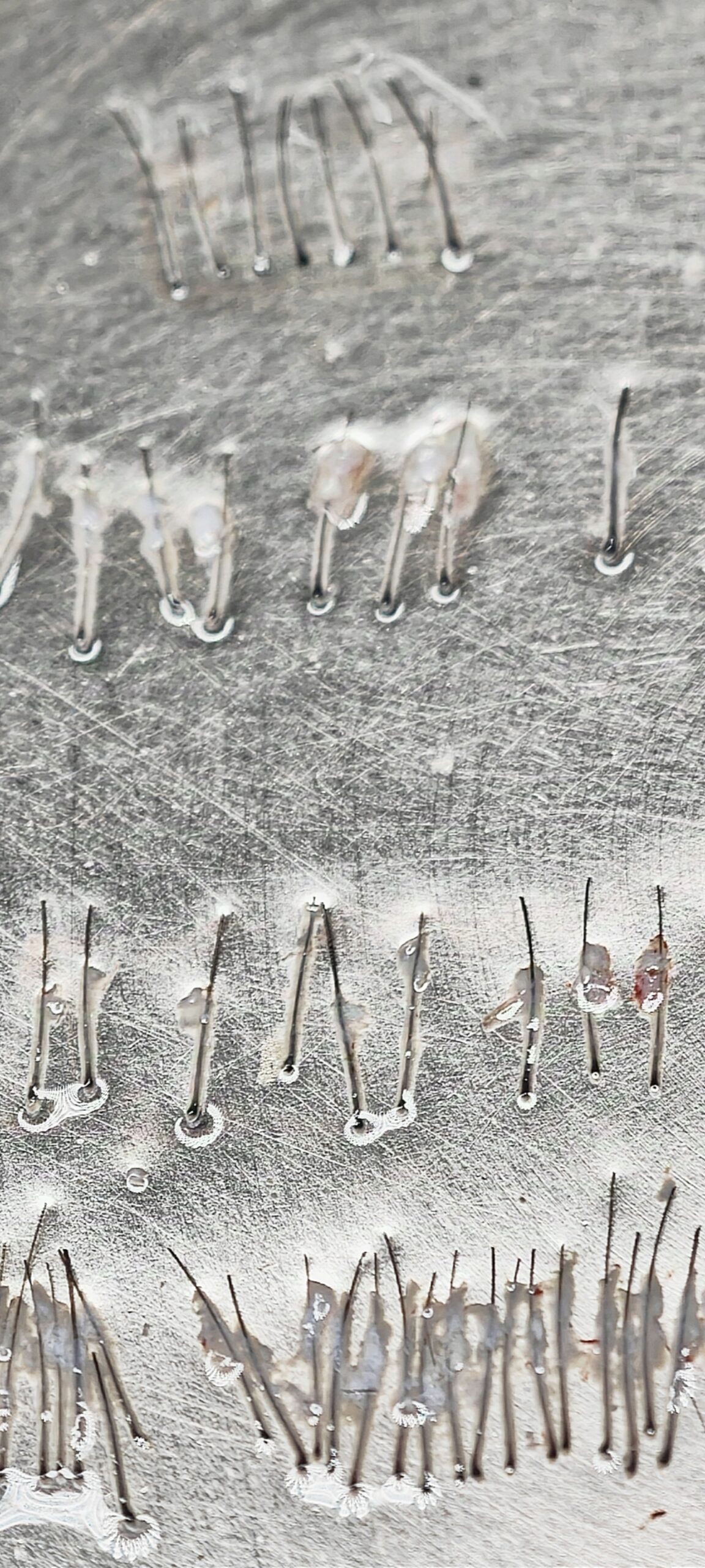 Temporal Points Hair Restoration - Absolute hair clinic