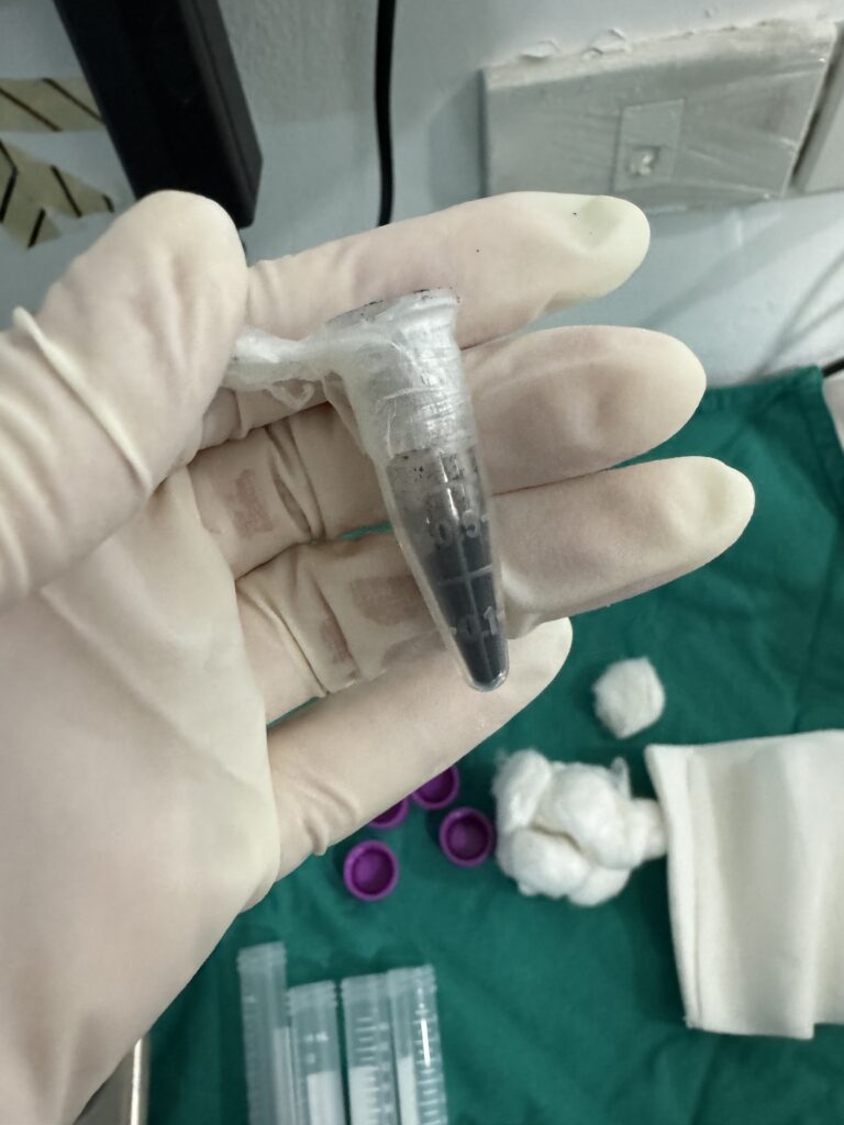 Verteporfin injection in Donor area after FUE - Absolute hair clinic