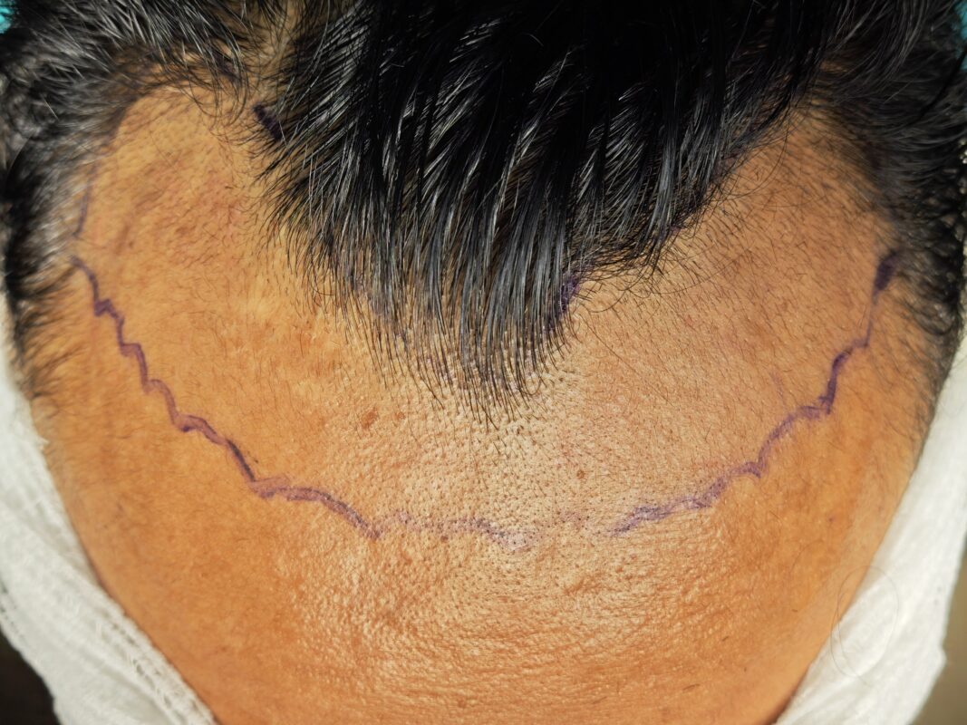 Cowlick at the hairline, follow or ignore it's direction? - Absolute ...