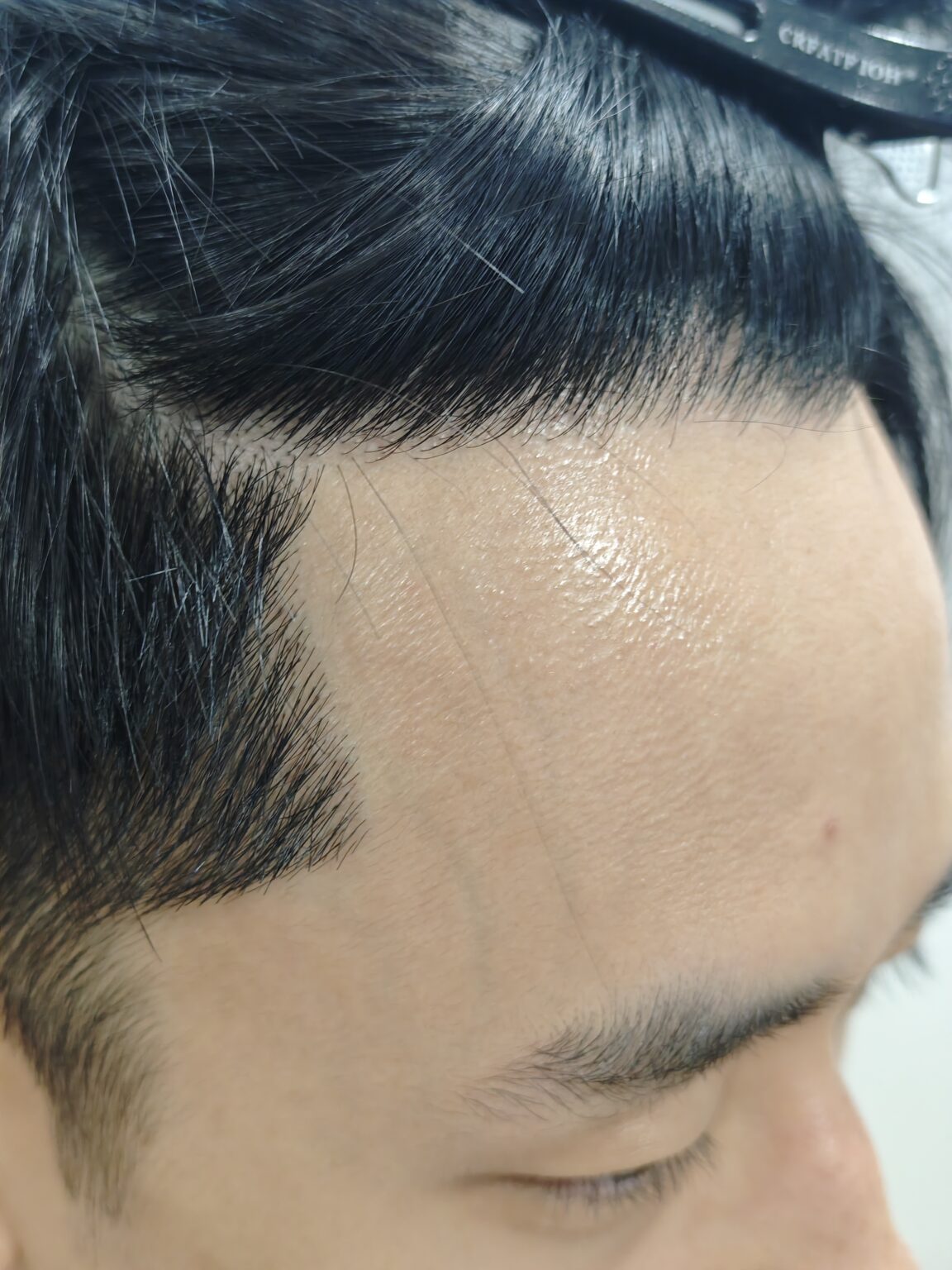 Temporal Points Hair Restoration - Absolute hair clinic