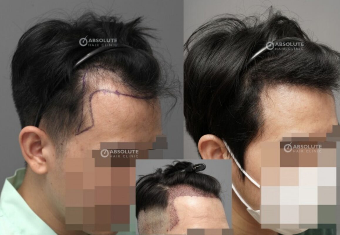 Temporal Points Hair Restoration - Absolute hair clinic