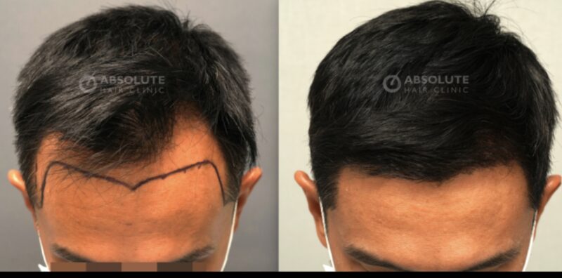 Temporal Points Hair Restoration - Absolute hair clinic