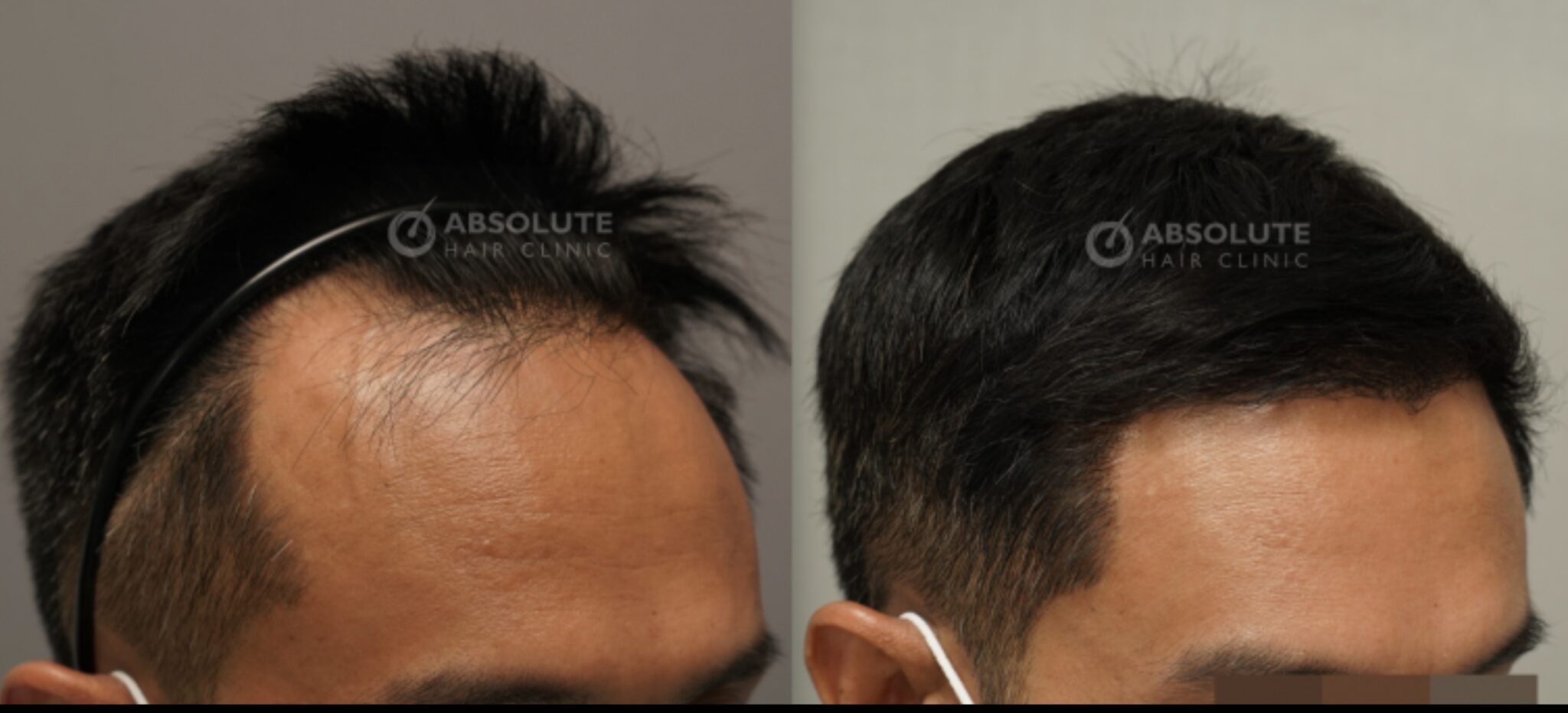 Temporal Points Hair Restoration - Absolute hair clinic