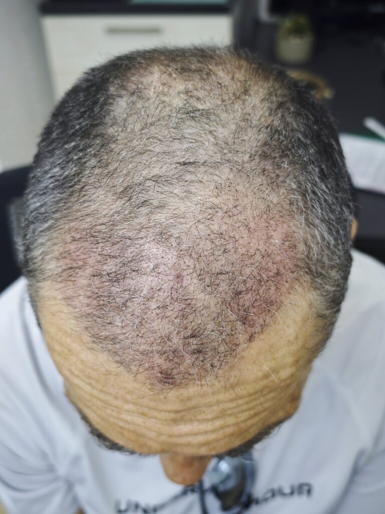 How to reduce redness in recipient site - Absolute hair clinic