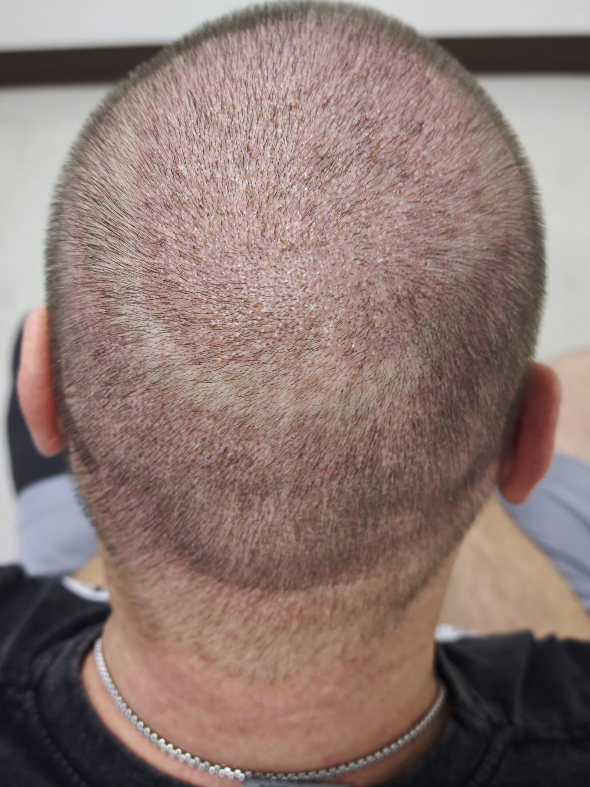 How to reduce redness in recipient site - Absolute hair clinic