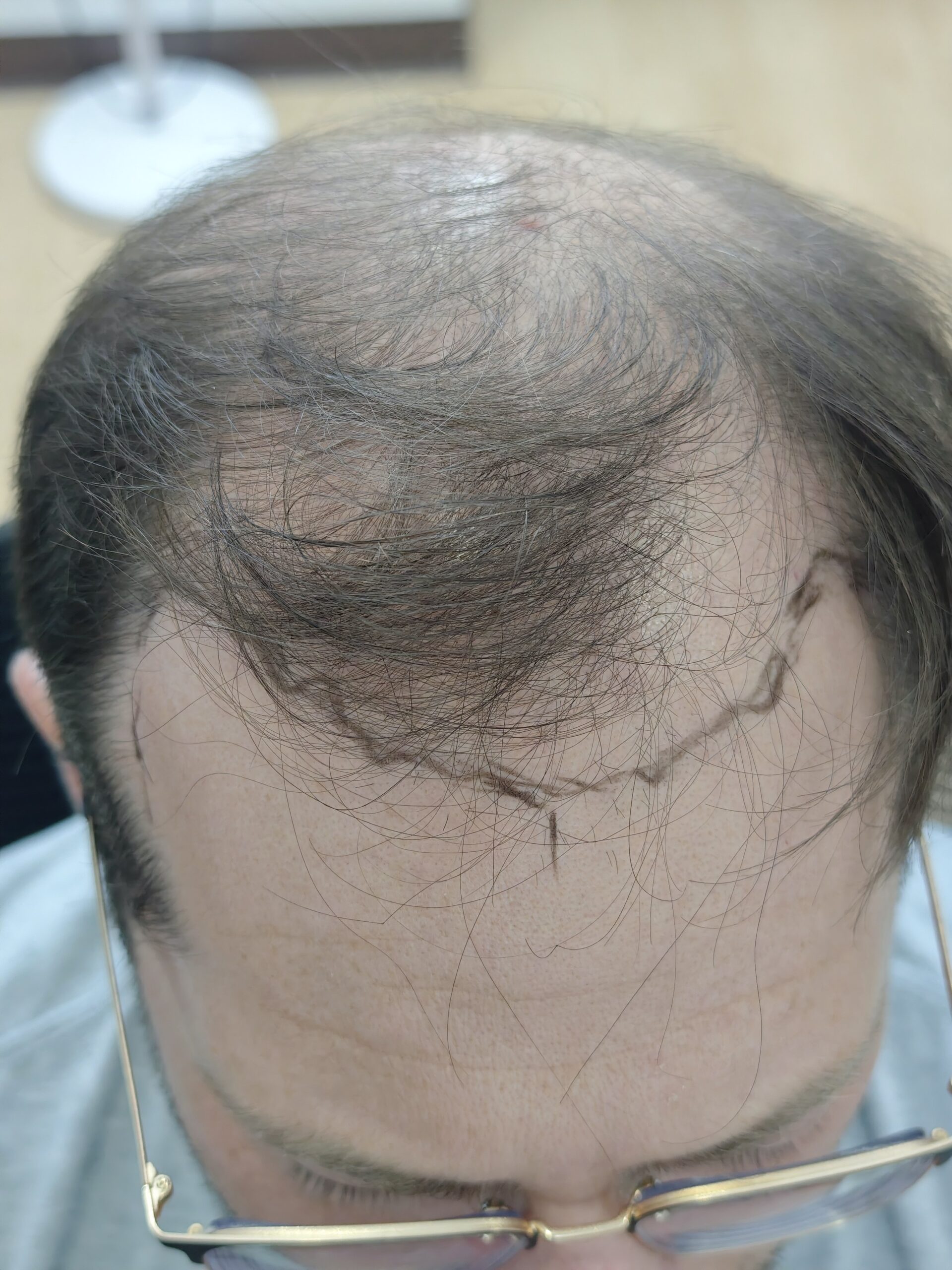 Surgical Plan for Class VI–VII Hair Loss - Absolute hair clinic